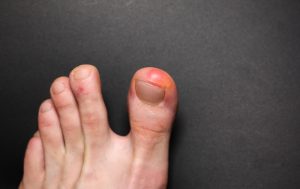 Foot Wounds in Glendale, AZ | Sole Foot & Ankle Specialists